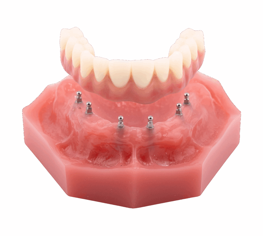 What Is an Implant Denture? | Big Sky Dentures & Implants